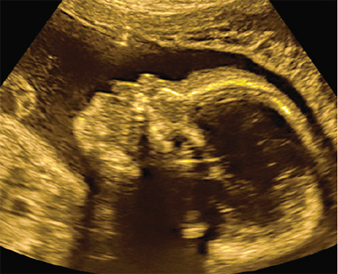 Study Finds Link Between Exposure to Synthetic Progestin During ...